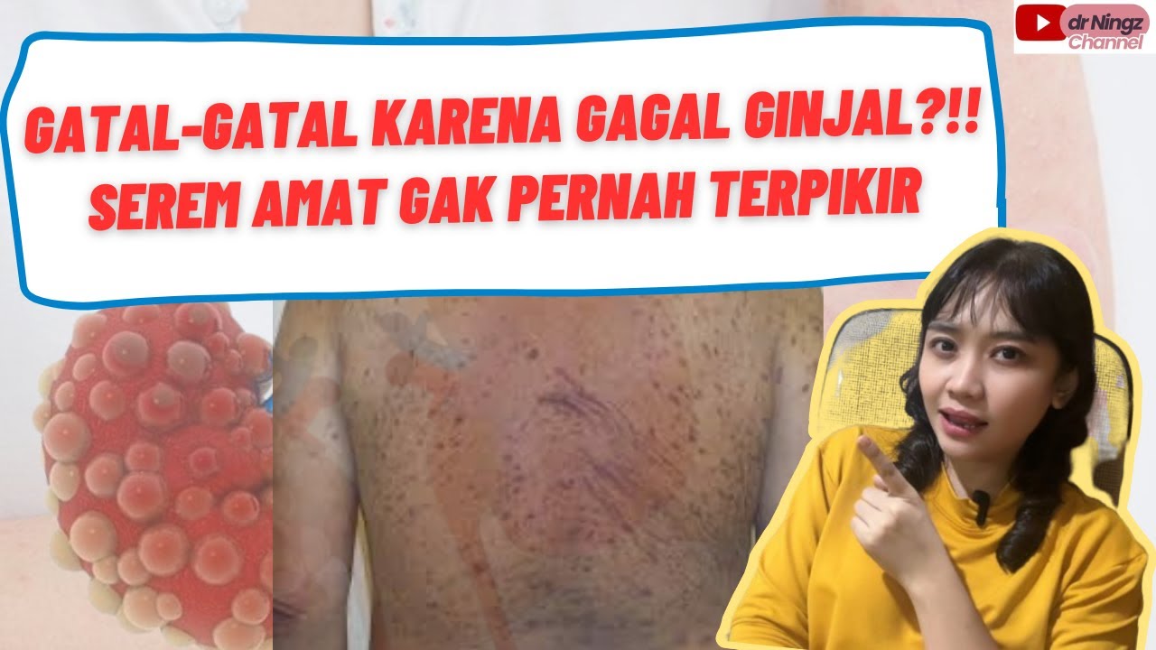 Gatal-Gatal Karena Gagal Ginjal?!! Serem Amat Gak Pernah Terpikir # ...