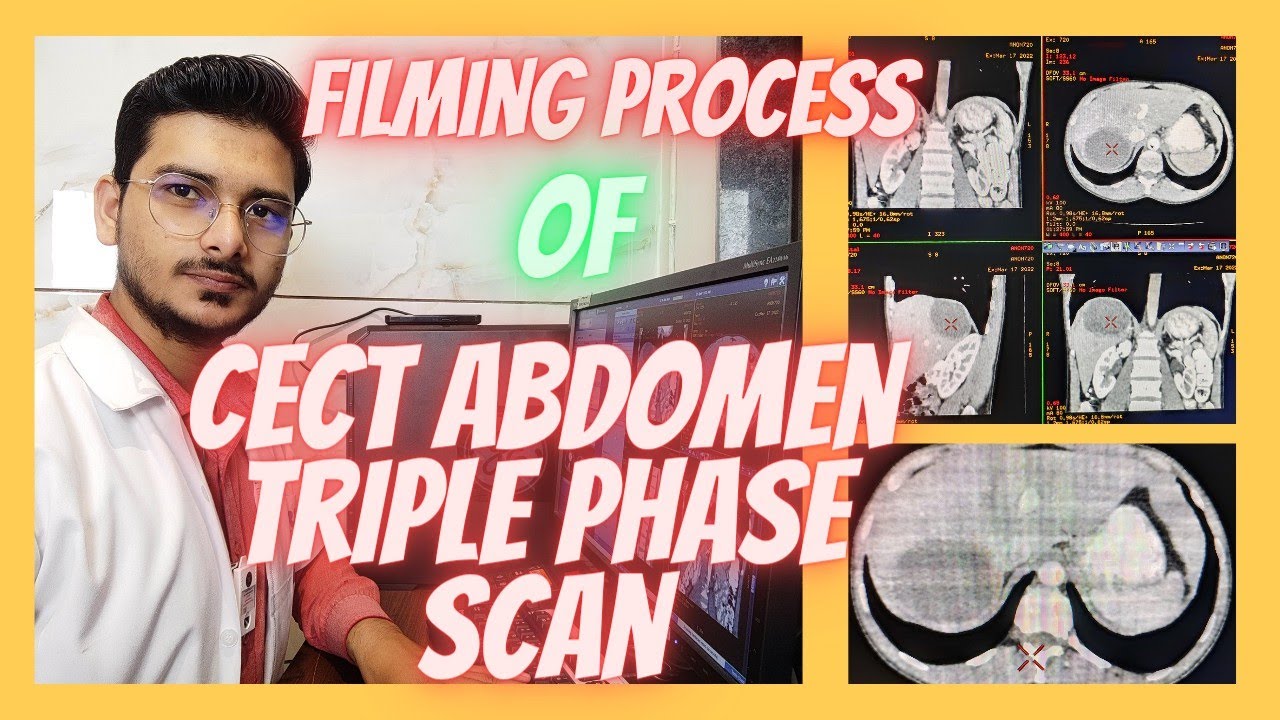 CT SCAN Abdomen Triple phase Filming process| Triphasic abdominal ...