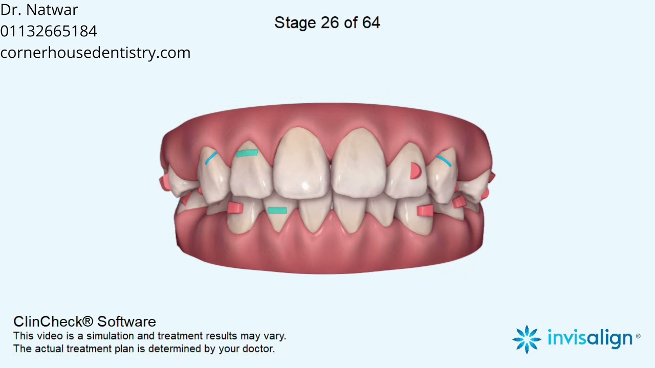 Anterior crossbite, Open bite, Asymmetric arches, Maxillary midline ...