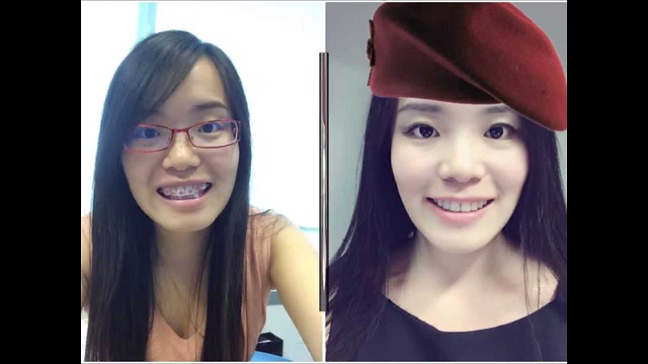 Braces off, time lapse, before and after transformation, adult - YouTube