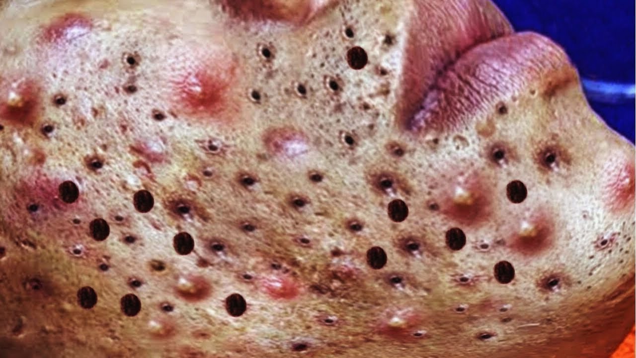 Extreme Blackheads Removal From Nose & Chin | No Talking Pore Cleaning ...