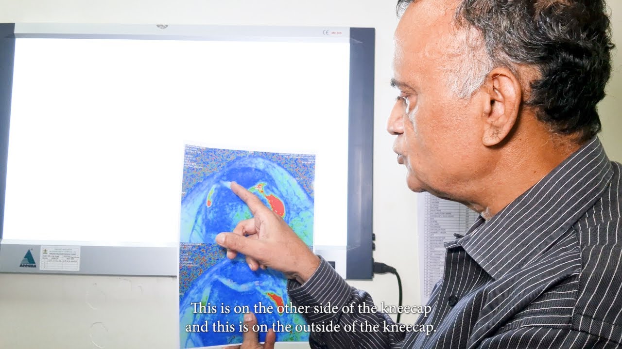 3T MRI cartigram is most valuable test for PRS treatment of knee ...