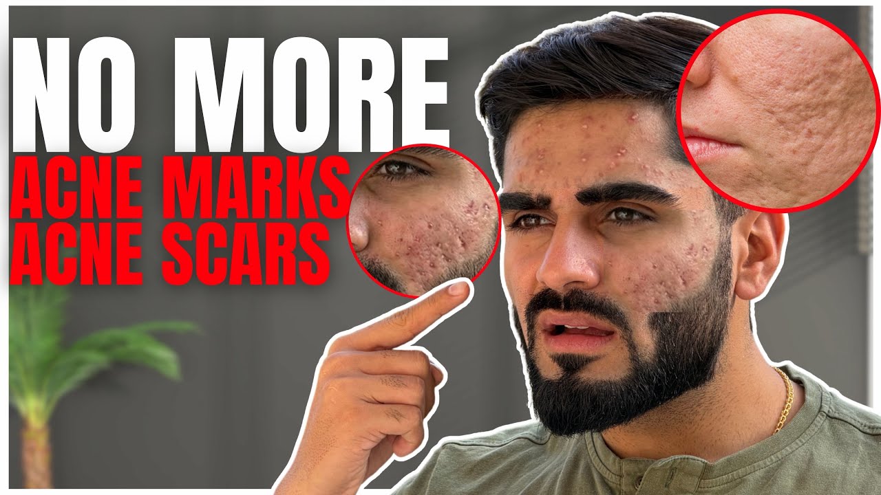 NO MORE ACNE MARKS & ACNE SCARS!😳 Ultimate Teenage Guide to Clear Skin ...