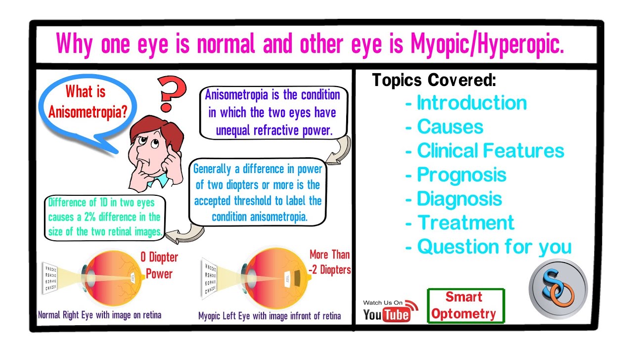 Why one eye is normal and other is Myopic or Hyperopic (Simple ...