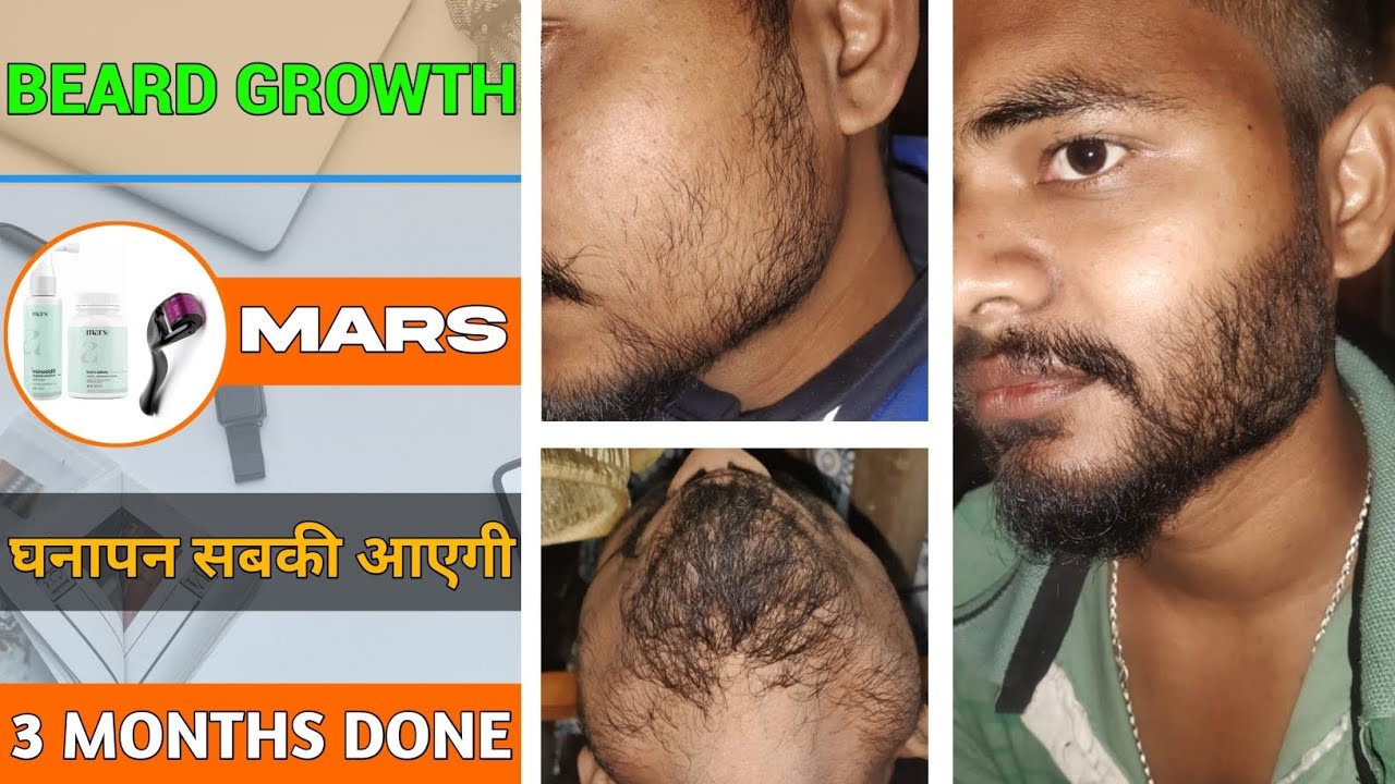 BEARD GROWTH 3 MONTHS DONE FROM MARS BY GHC MINOXIDIL || दाढ़ी में ...