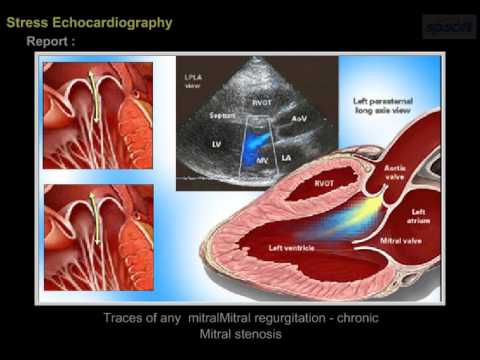 Stress Echo Cardiography - YouTube