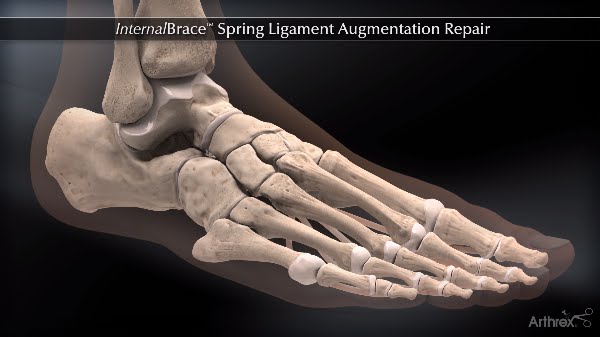 InternalBrace™ Spring Ligament Augmentation Repair - YouTube