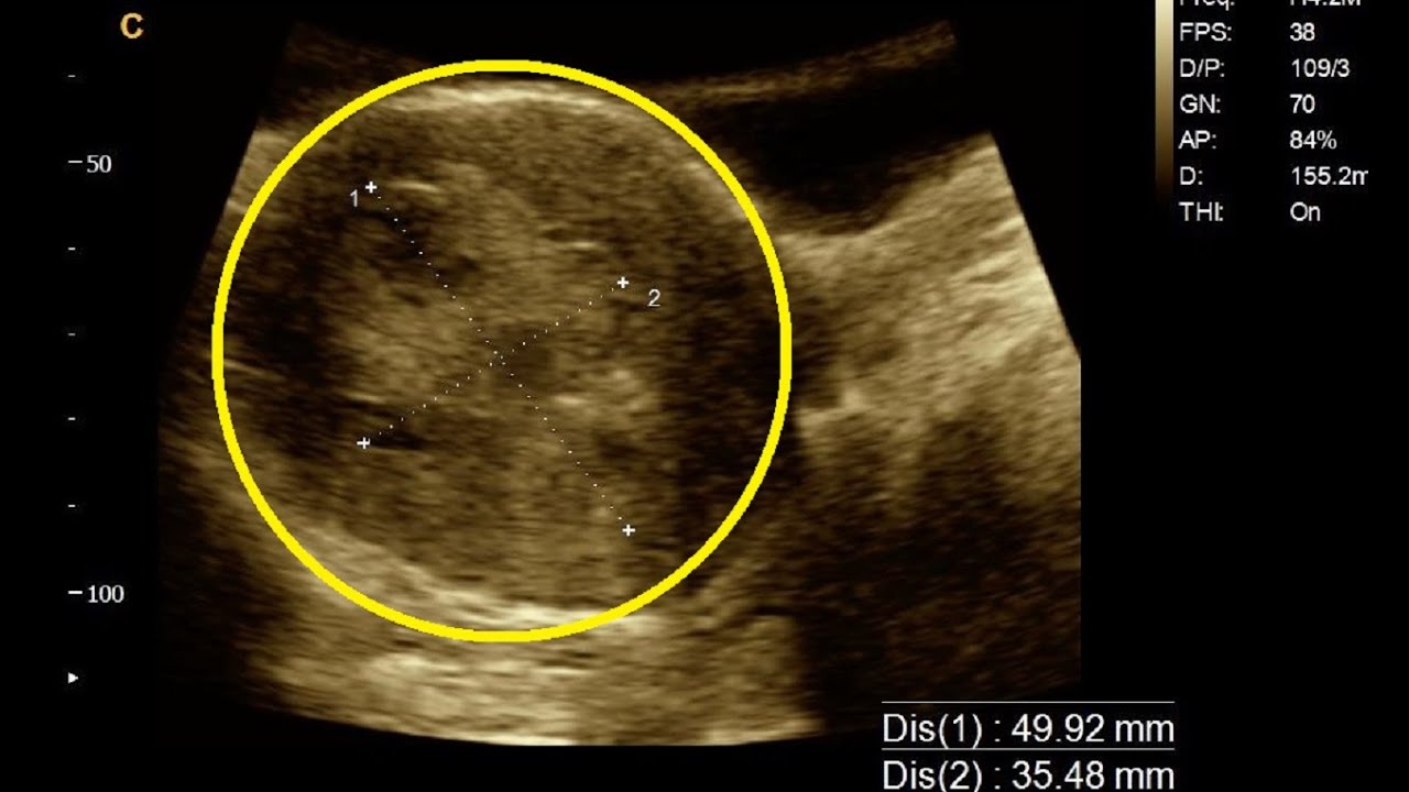 Incomplete abortion of molar pregnancy | USG scan Format | Amader ...