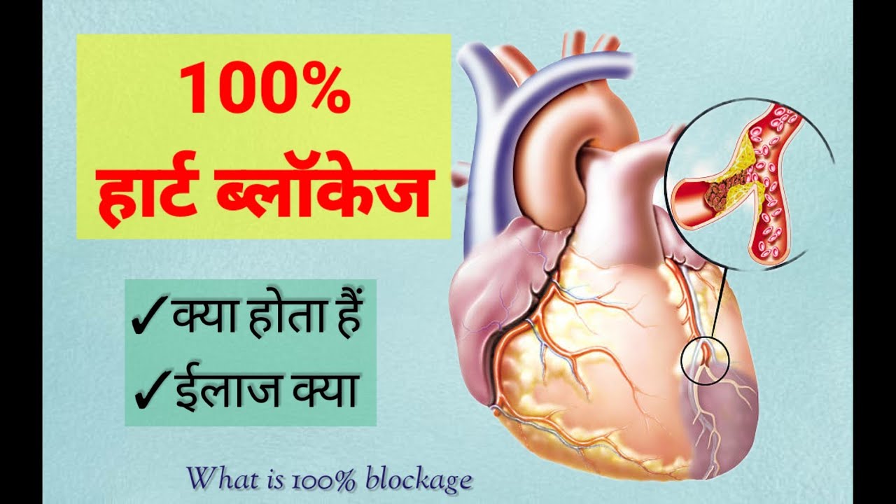 100% heart Blockage Treatment #drnagendrathalor - YouTube