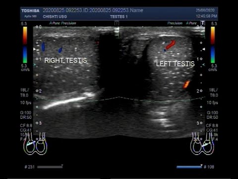 Ultrasound Video showing Testicular microlithiasis, an uncommon case ...