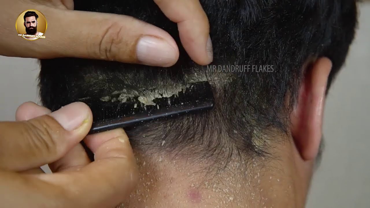 Big Dandruff Flakes Scratching Satisfying 256 Youtube
