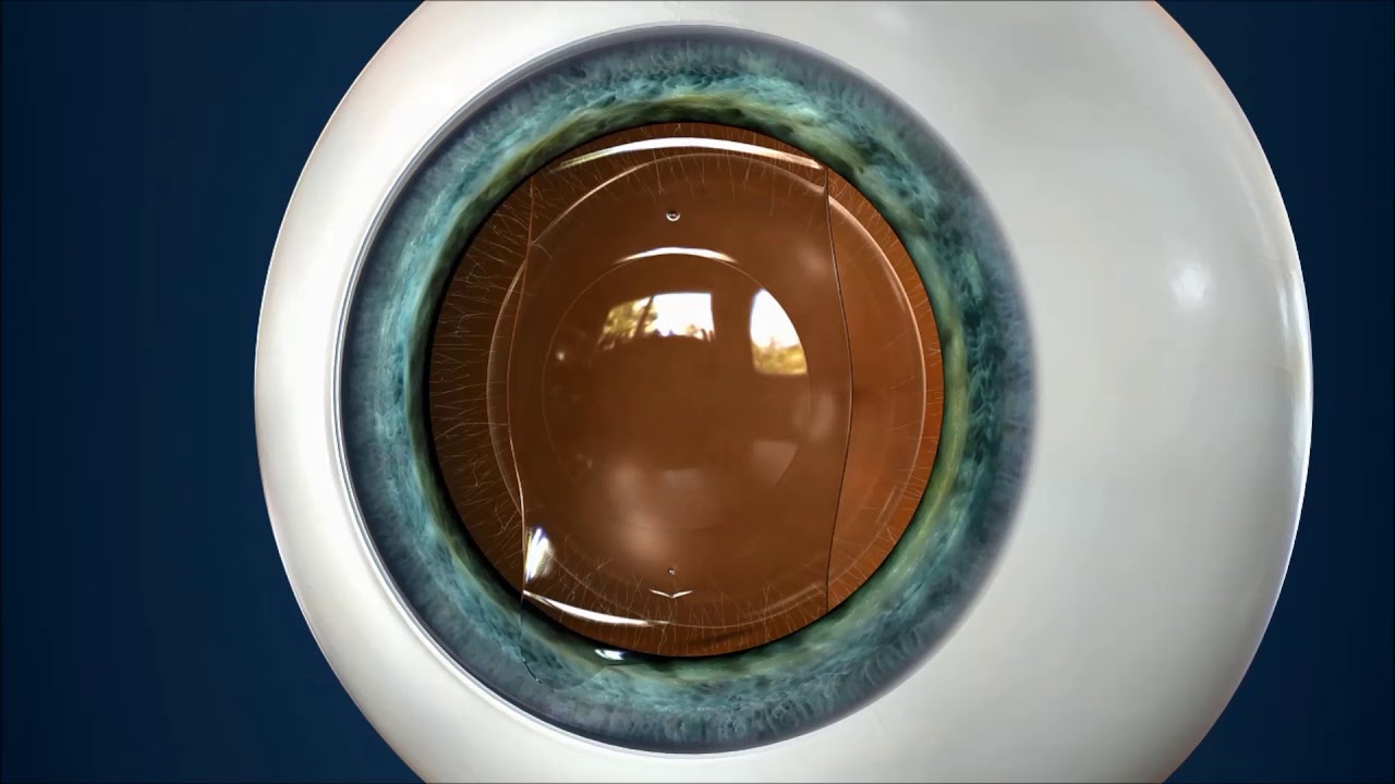 ICL Intraokularlinse - YouTube