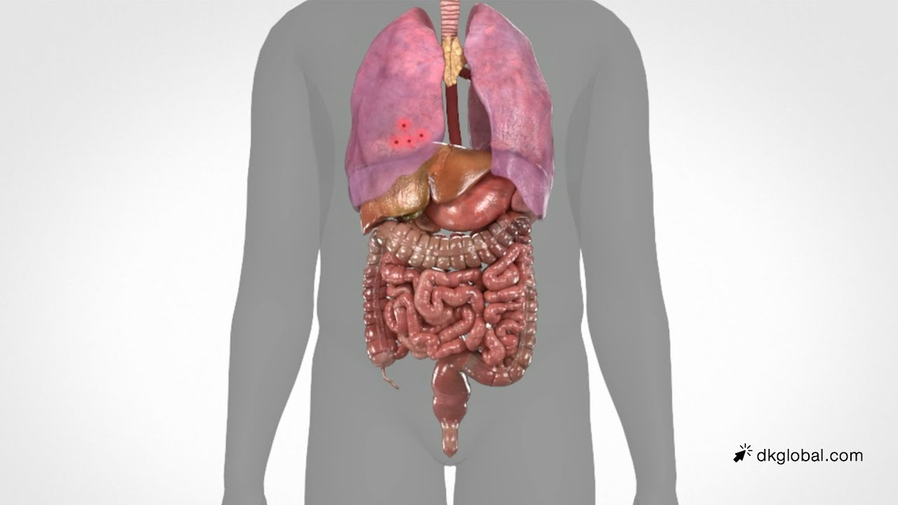 Medical Malpractice Timeline Animation Aids in Settlement 4x Initial ...