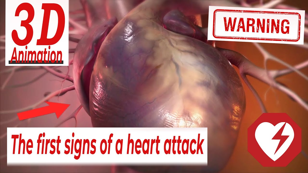 The first signs of a heart attack | 3D Animation - YouTube