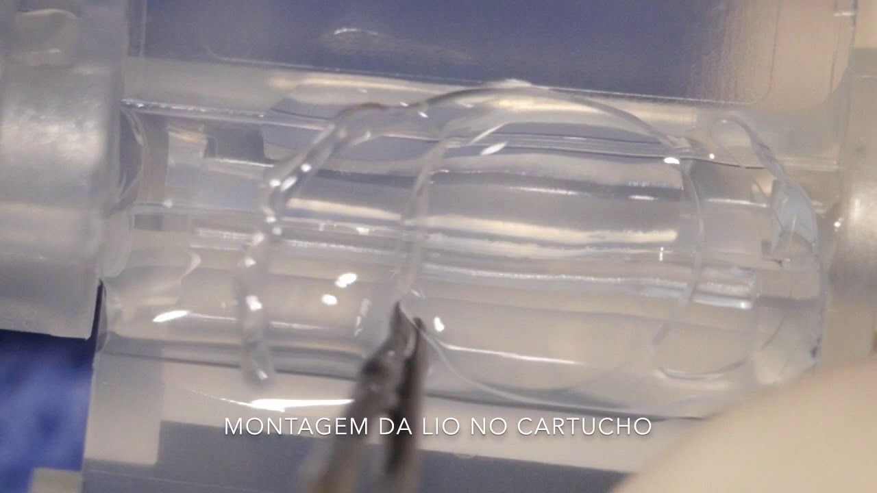 Implante de lente sulcoflex - YouTube