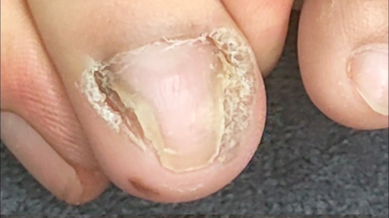 PART2 THE CRAZIEST TOENAIL EVER WITH WARTS AND FUNGUS. - YouTube