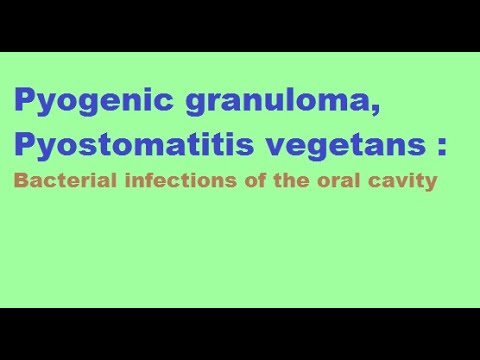 Pyogenic Granuloma, Pyostomatitis vegetans: Bacterial infections of the ...