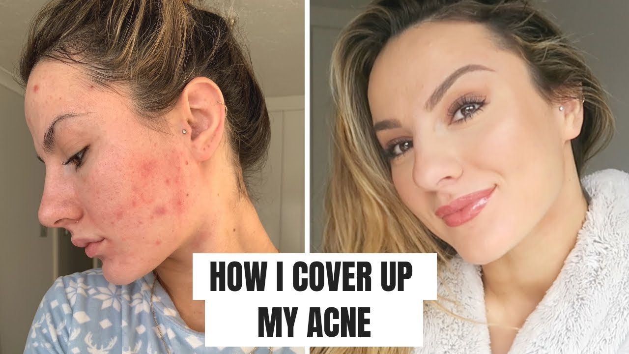 GET READY WITH ME: How I Cover Up My Acne! - YouTube