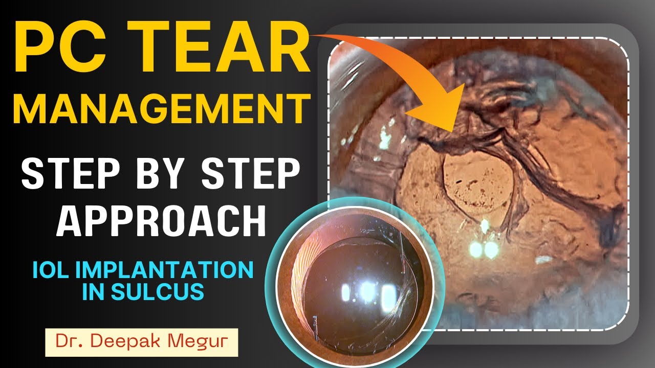 PC tear management and Sulcus IOL Implantation - Step by step approach ...
