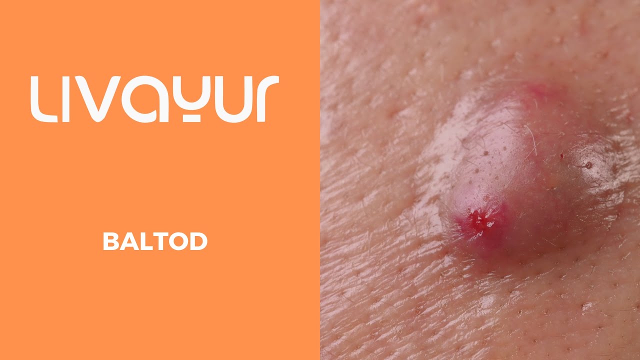 Baltod (Boils) | Causes, Symptoms & Natural Treatment - YouTube