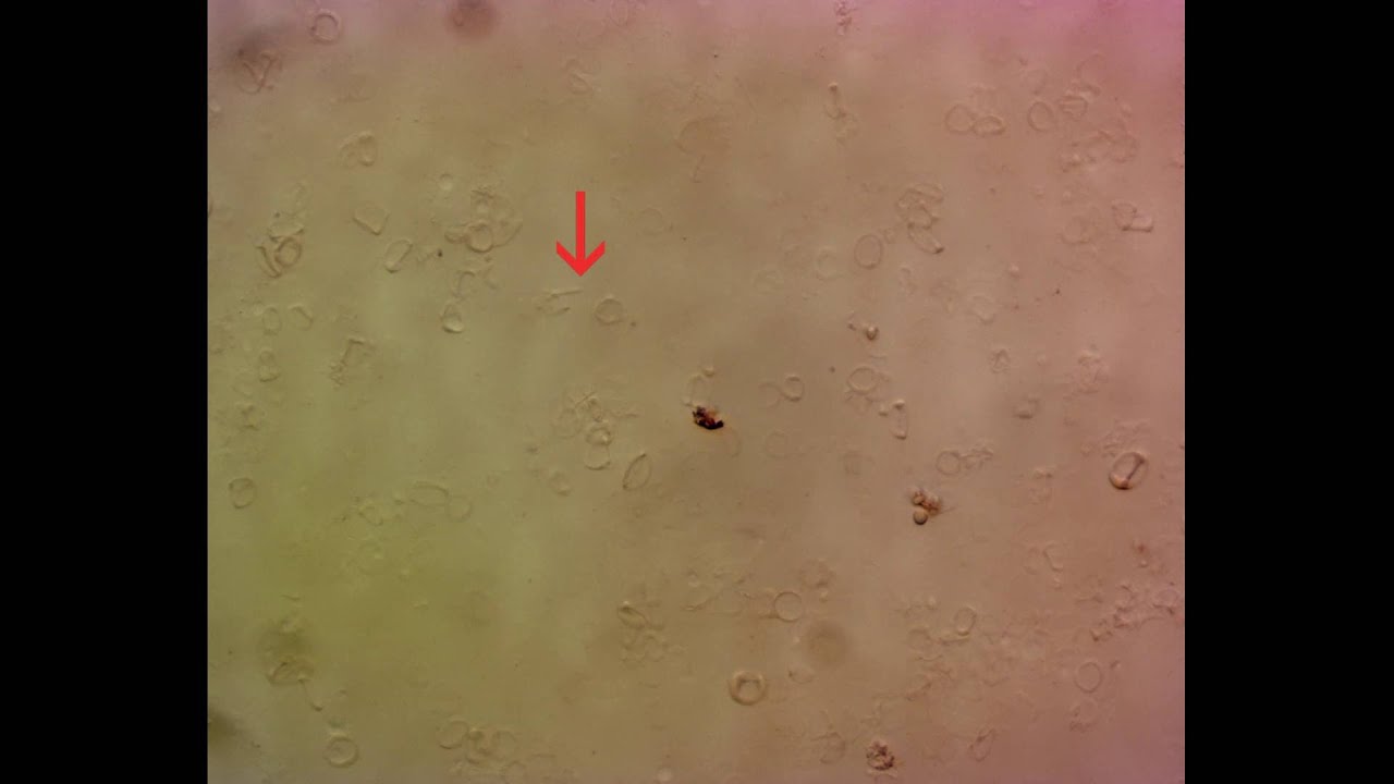 Lyme Disease (Borrelia burgdorferi?) forms cyst - YouTube