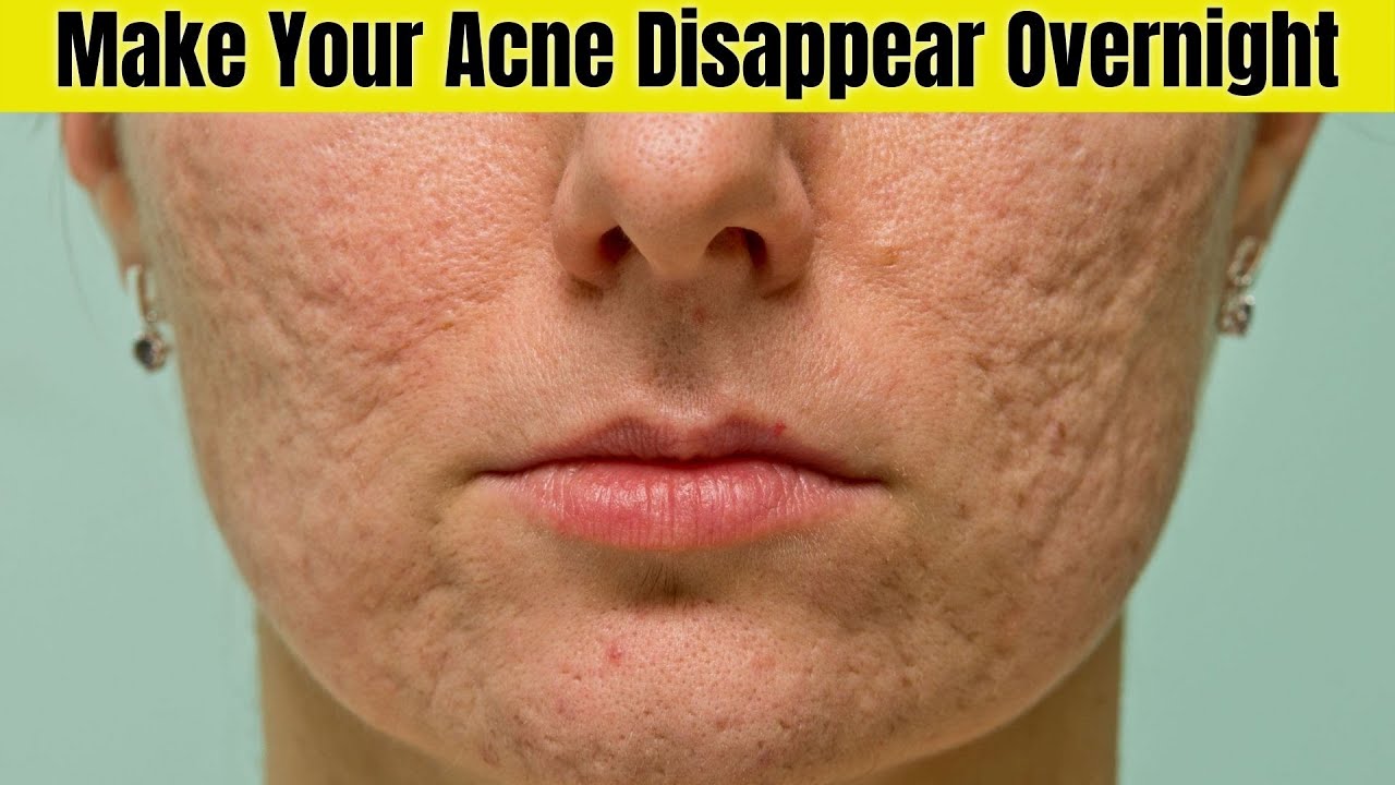 How To Make Your Acne Disappear Overnight | Easy Way - YouTube