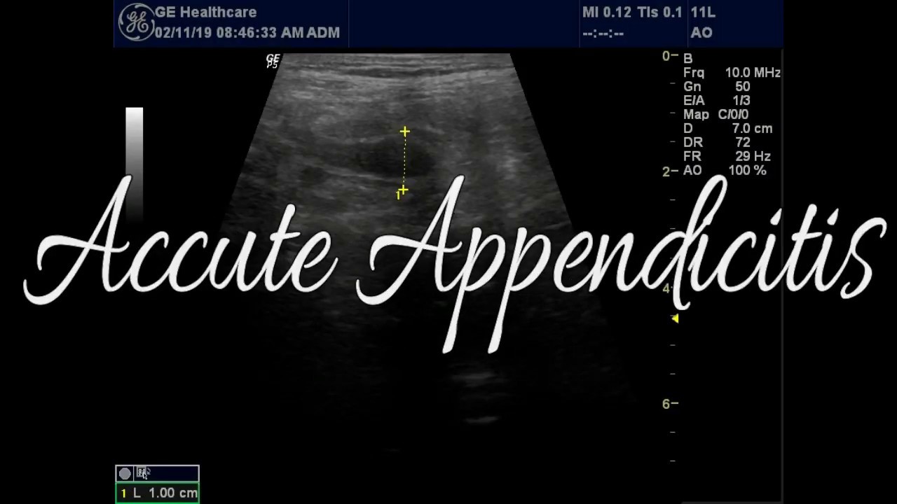 Acute Appendicitis Ultrasound Youtube