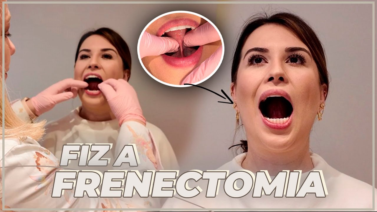 POR QUE FIZ FRENECTOMIA? + ANTES E DEPOIS, RESULTADOS E PÓS OPERATÓRIO ...
