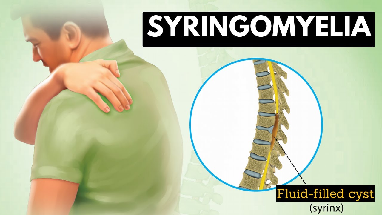 Syringomyelia: Everything You Need To Know - YouTube
