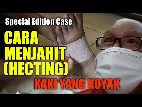 CARA MENJAHIT (HECTING) KAKI YANG KOYAK || #papagen #hecting #kakiluka ...