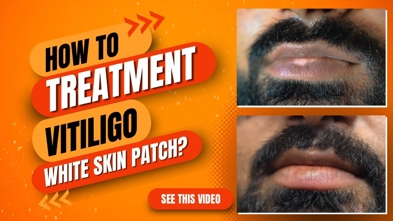Lip Vitiligo treatment | Best solution for white skin patch | No side ...