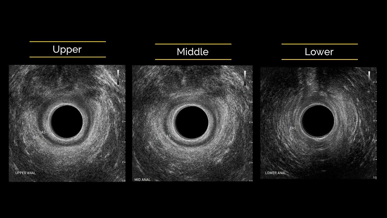 Endoanal ultrasound - YouTube