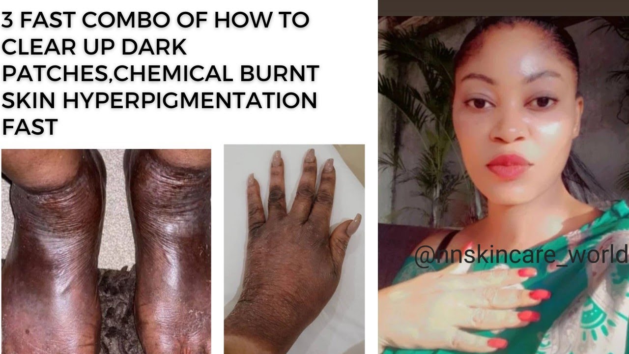 3 FAST COMBO TO CLEAR DARK PATCHES, CHEMICAL BURNT SKIN HYPERPIMENTION ...