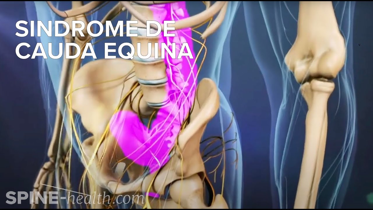 Síndrome de Cauda Equina - YouTube