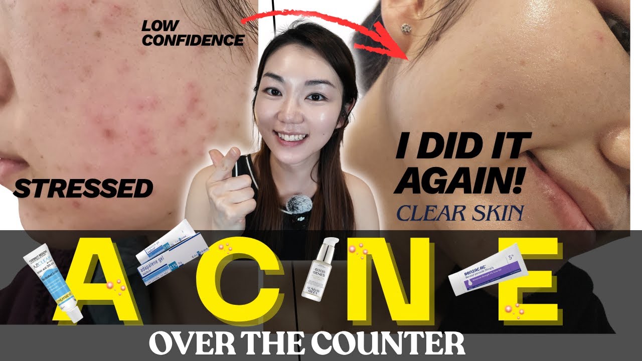 How To Get Clear Skin On Asian Skin (Skin Therapist Get Bad Skin TOO ...