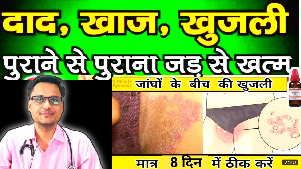 daad khujli ko jad se khatm karne ke upay/daad khujli ki cream/fungal ...