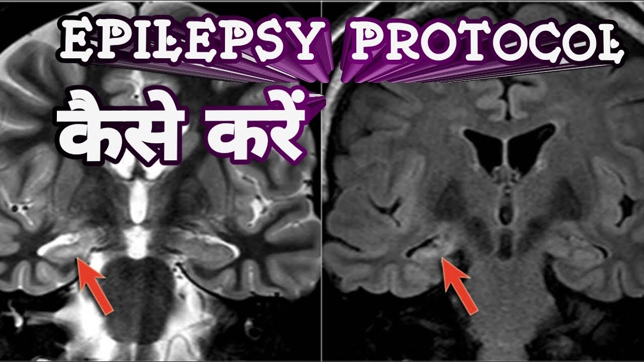 MRI Brain में EPILEPSY PROTOCOL को कैसे करें, A SPECIAL PROCEDURE FOR ...