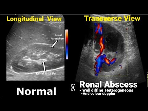 Kidney Ultrasound Normal vs Abnormal Appearances Comparison - YouTube