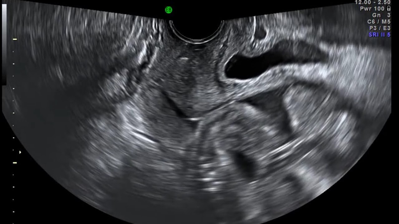 CERVICAL INCOMPETENCE TRANS VAGINAL ULTRASOUND - YouTube