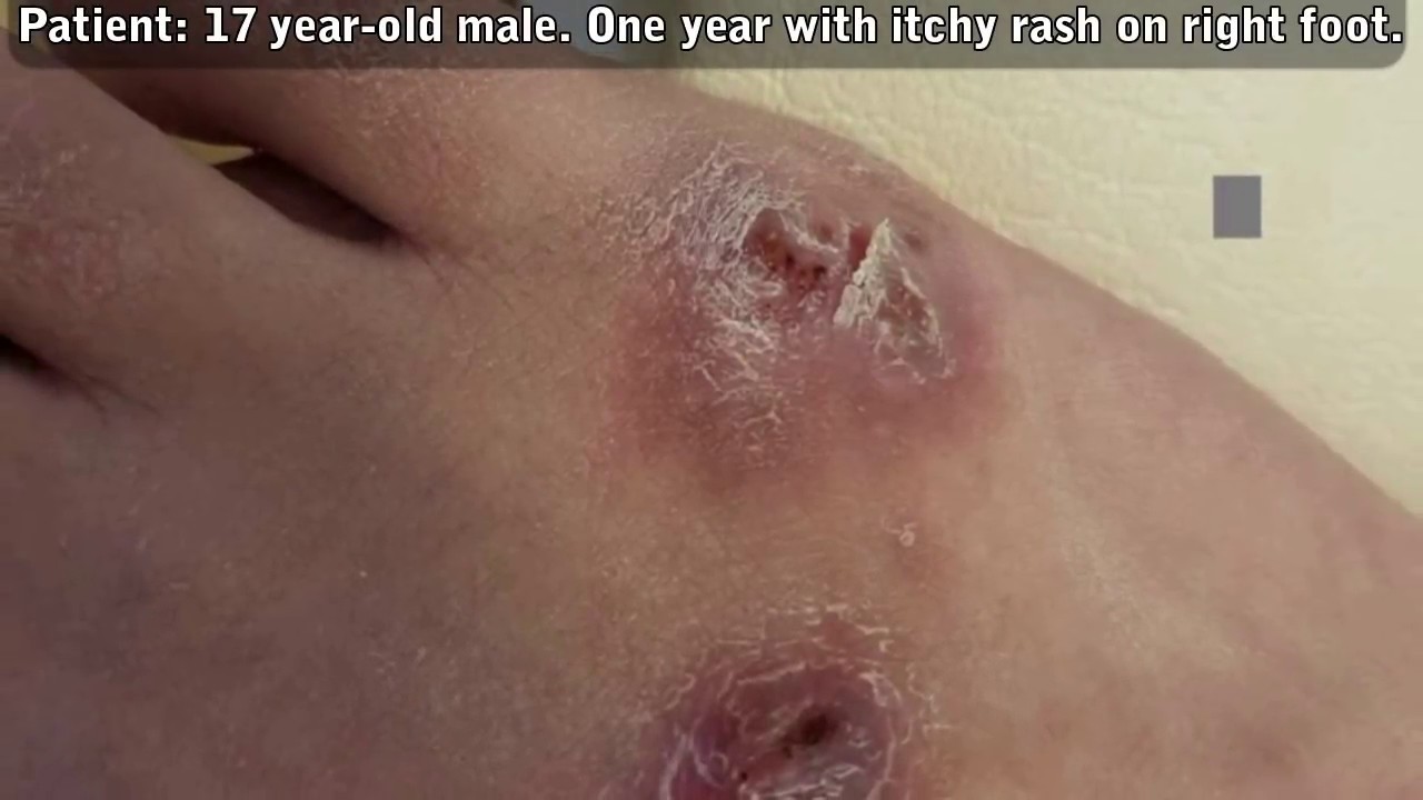 Staph Infection or Spider Bite on Foot? - YouTube