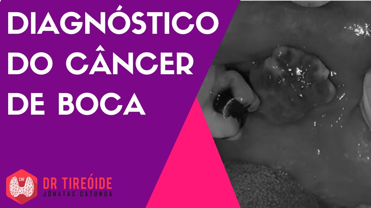 Diagnóstico do câncer de boca - Dr Jônatas Catunda - YouTube
