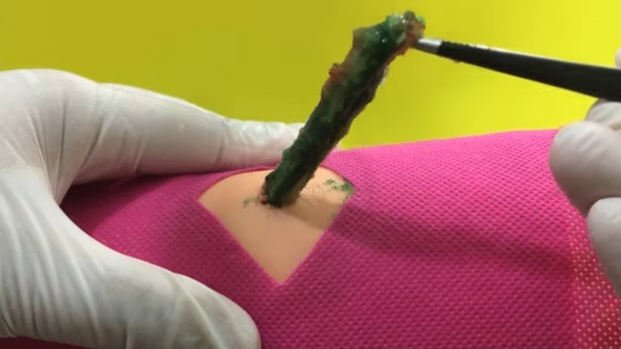 BEST Pimple Popping // Big Cystic Acne Blackheads / Whiteheads Removal ...