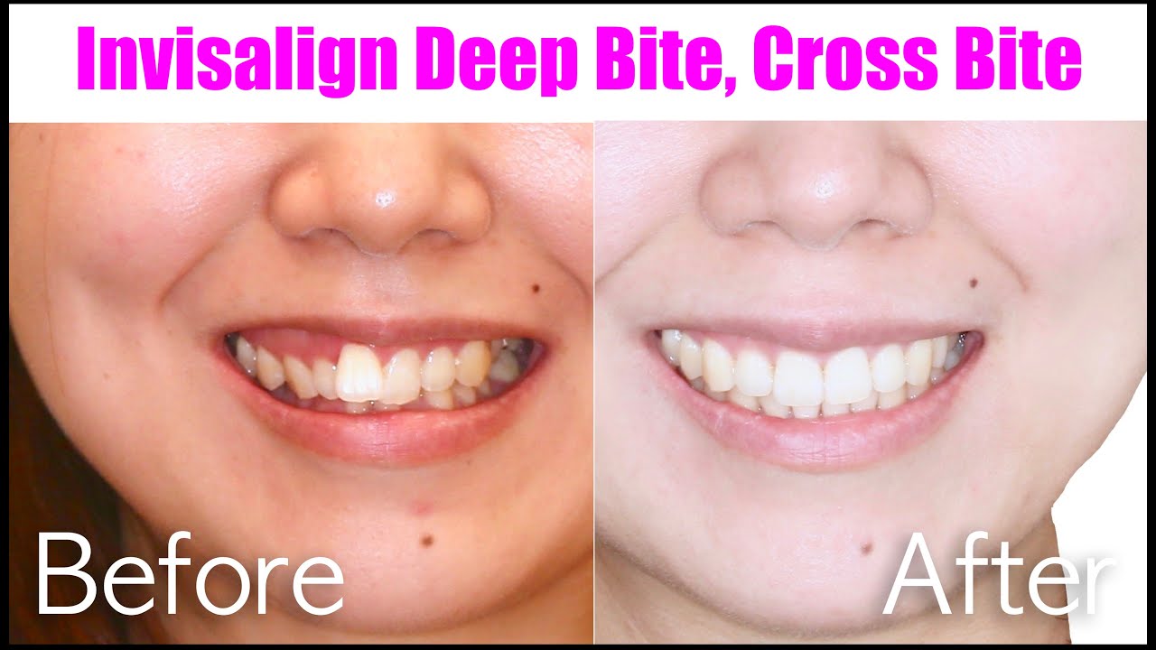 Invisalign Crossbite, Deepbite Non extraction Approach. - YouTube
