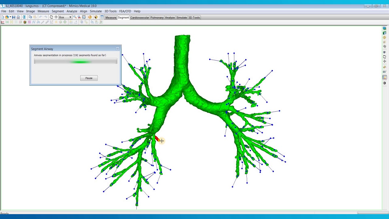 How to Automatically Segment Airways | Mimics Innovation Suite ...