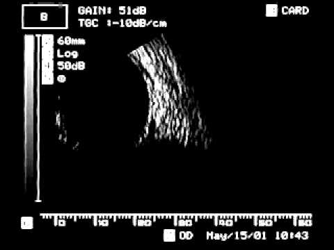 Subtenon's Injection