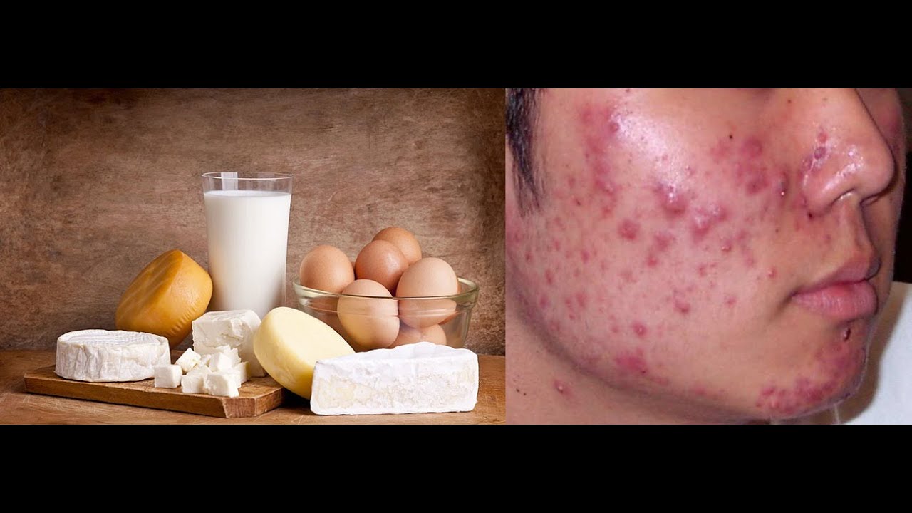 Top 5 ACNE Causing Foods! - YouTube
