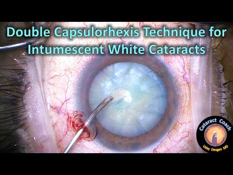 Double Capsulorhexis for Intumescent White Cataract Surgery - YouTube