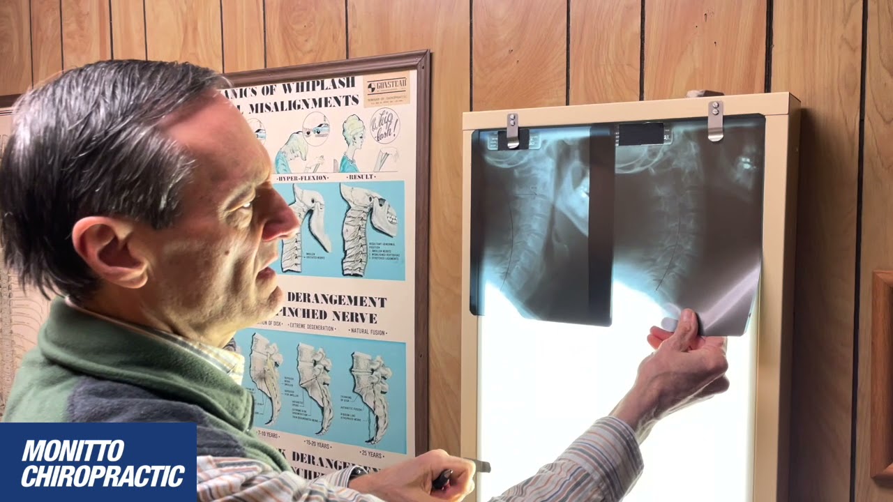 Forward Head Posture Before and After X Rays - YouTube