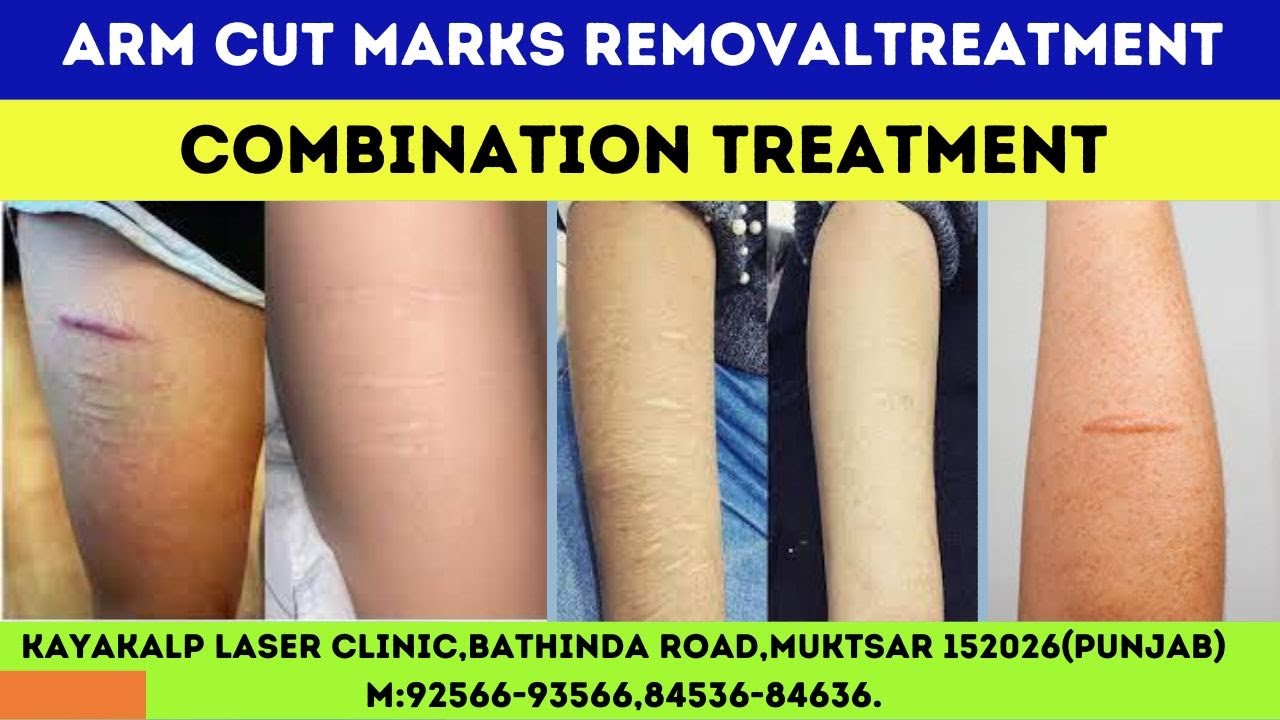 Arm Cut Marks Removal Treatment | Combination Treatment - YouTube