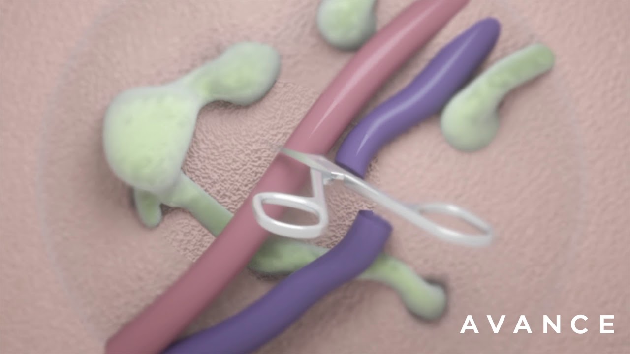 Lymph node Transfer Dr. Erez Dayan Avance Plastic Surgery - YouTube